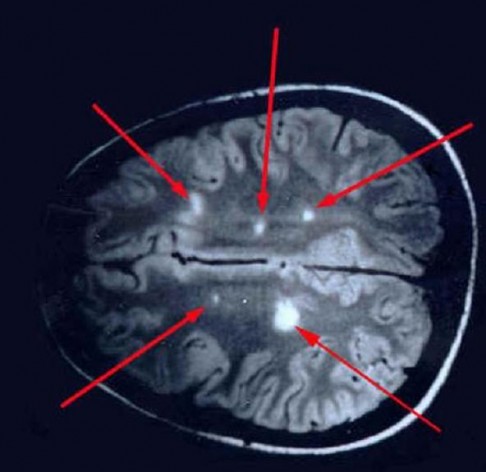 esclerosis múltiple | Somos Pacientes