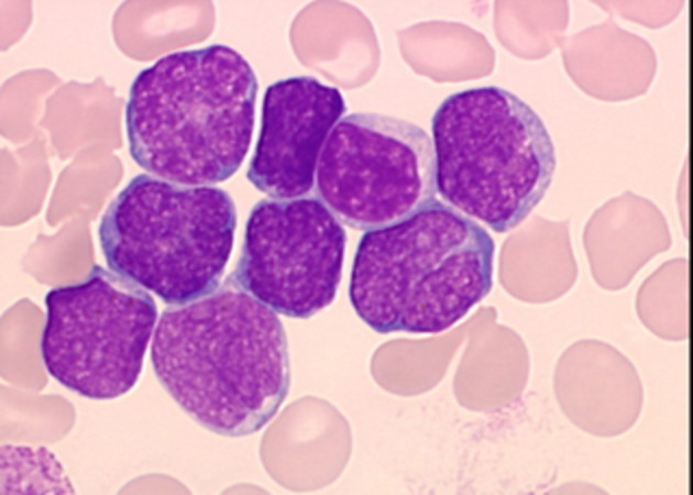 ‘Proyecto Lydia’ para la investigación de la leucemia aguda infantil