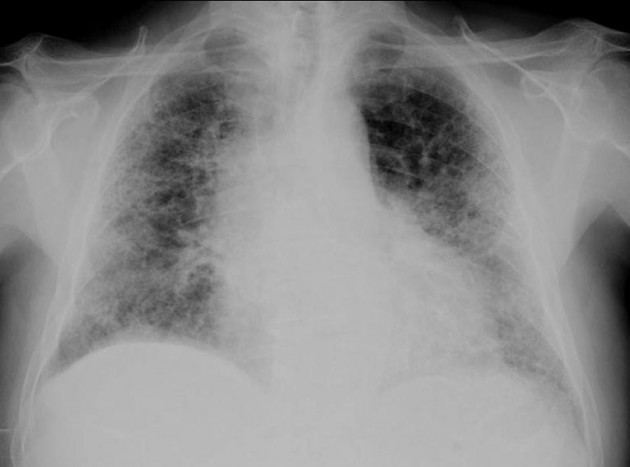fibrosis pulmonar idiopática | Somos Pacientes