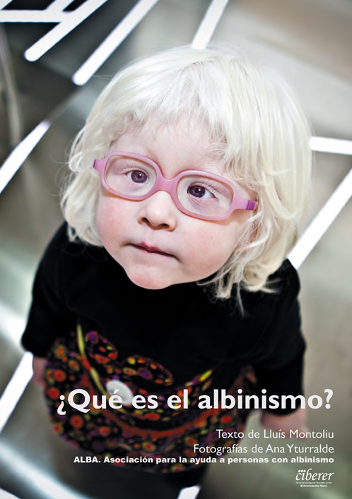 ¿Qué es el albinismo? | Somos Pacientes